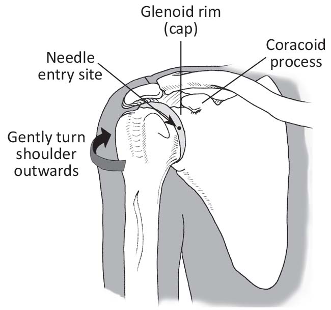 Joint aspirations and injections | RPHCM