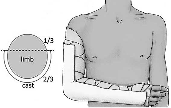Plaster of Paris (POP) slabs | RPHCM