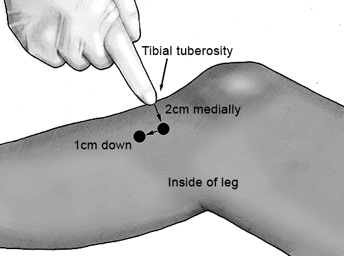 Putting in intraosseous needle | RPHCM