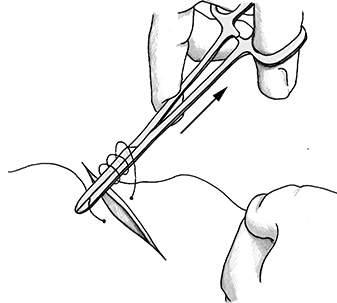 Closing a wound | RPHCM
