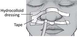 Putting in nasogastric tube (NGT) | RPHCM