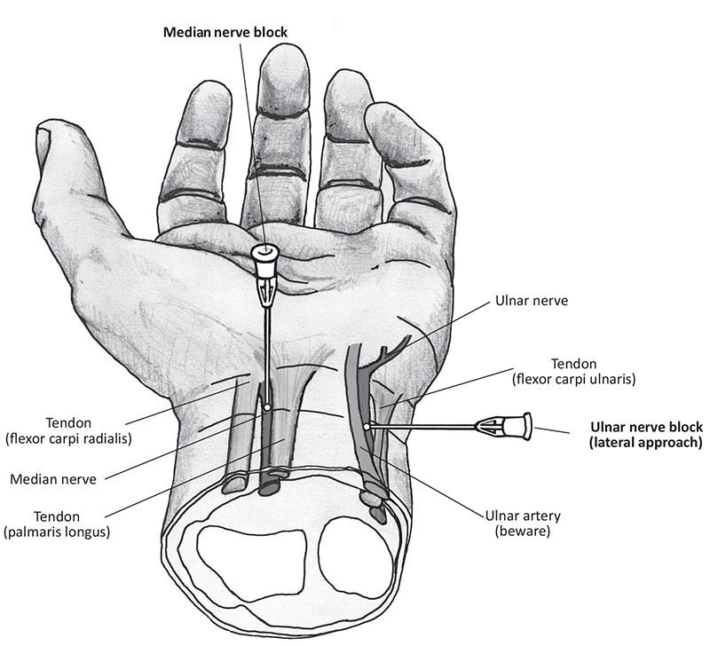Nerve and ring blocks | RPHCM