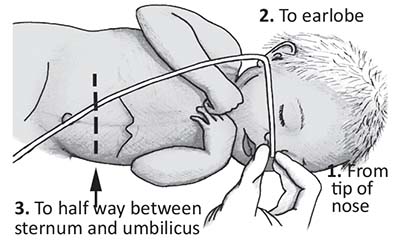 Putting in nasogastric tube (NGT) | RPHCM