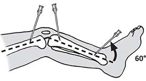 Putting in intraosseous needle | RPHCM