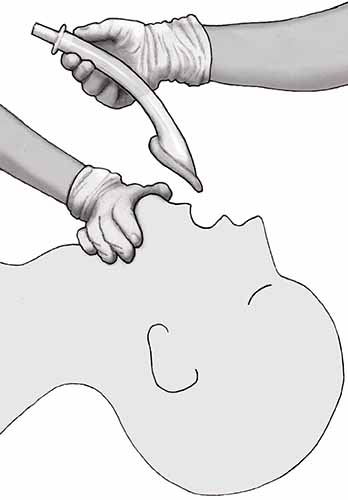 Advanced airway management | RPHCM