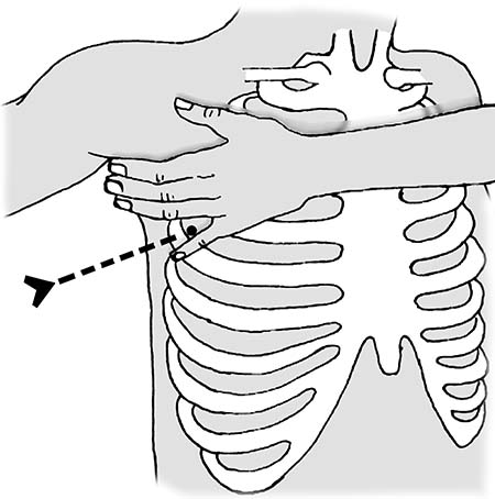 Chest procedures | RPHCM