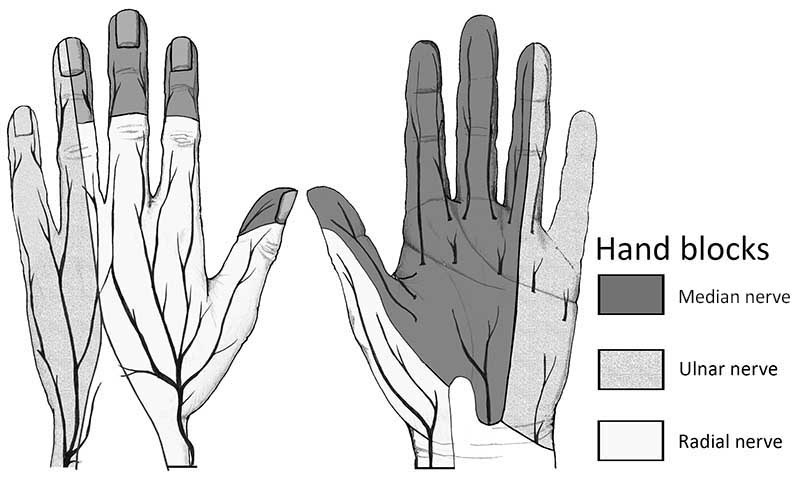 Nerve and ring blocks | RPHCM