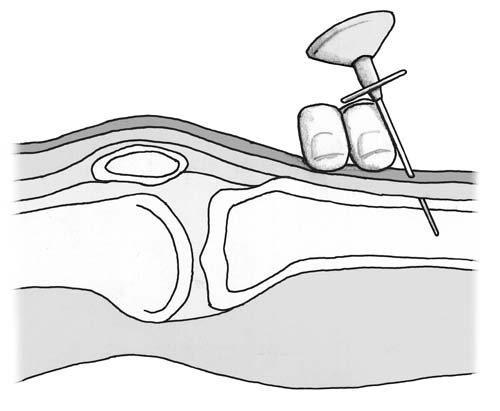 Putting in intraosseous needle | RPHCM