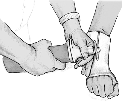 Taking off a cast | RPHCM