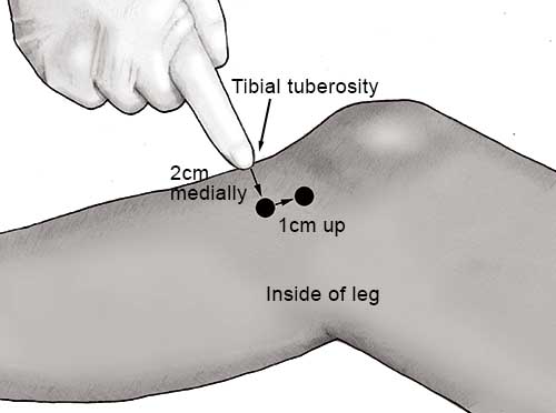 Putting in intraosseous needle | RPHCM