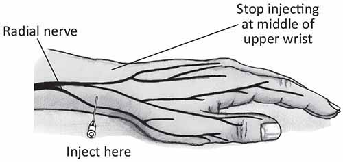 Nerve and ring blocks | RPHCM