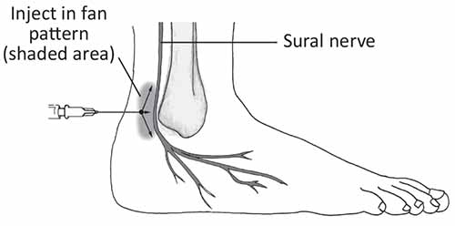 Nerve and ring blocks | RPHCM