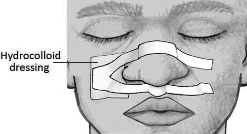 Putting in nasogastric tube (NGT) | RPHCM