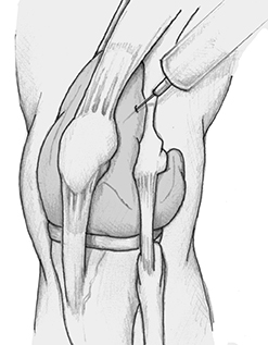 Joint aspirations and injections | RPHCM